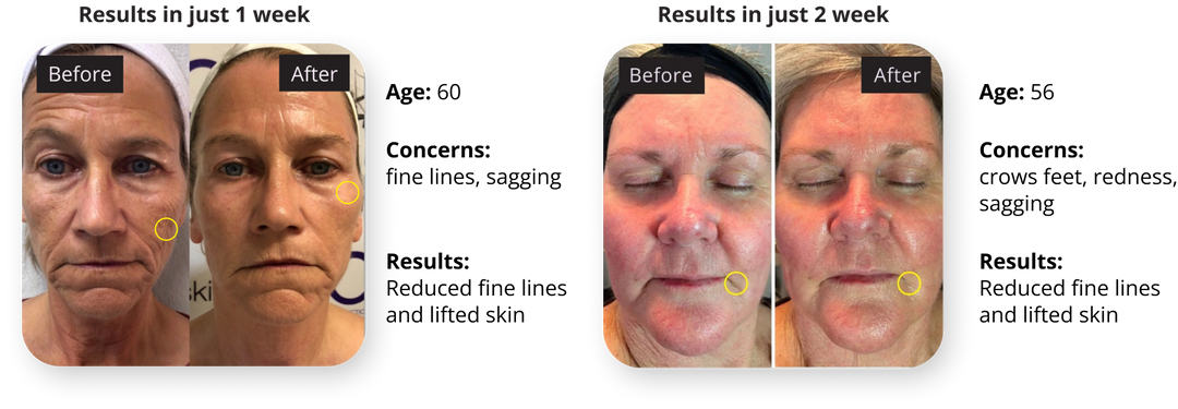 Face Microcurrents| MyoLift Mini Device for face – 7E Wellness